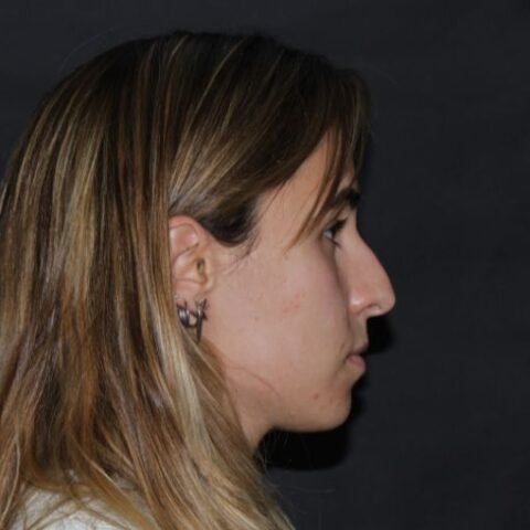 Fotos rinoplastia antes y después del Dr Simón en Valencia