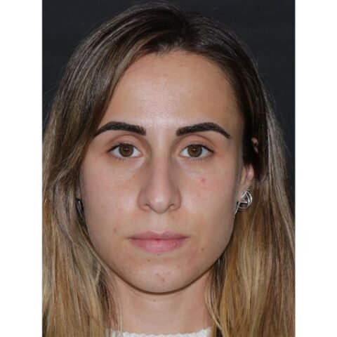 Fotos rinoplastia antes y después del Dr Simón en Valencia